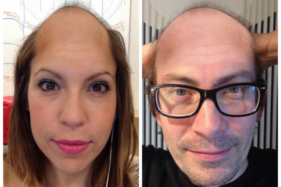 Descubre cómo estarías sin pelo en el Día Mundial de los calvos ...