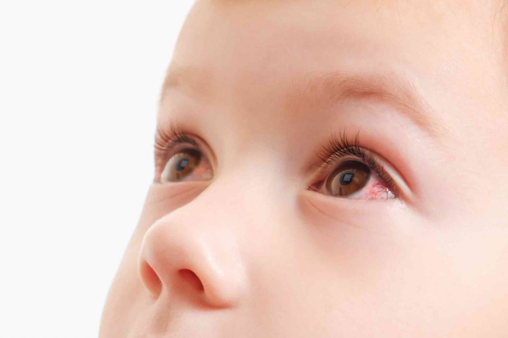 Conjuntivitis en bebés: esto es lo que debes hacer