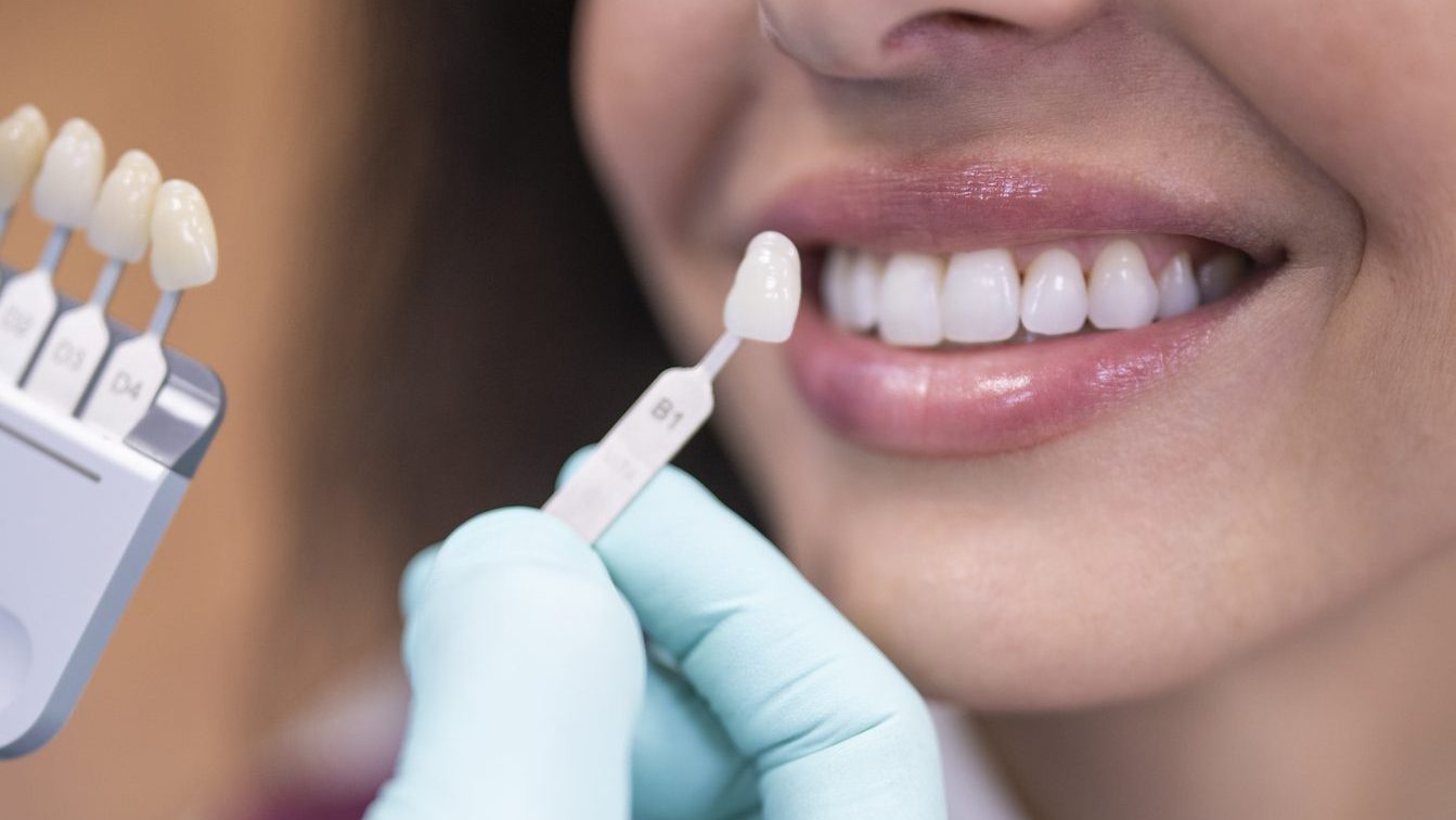 Si estas pensando ponerte carillas de porcelana en los dientes, debes ...